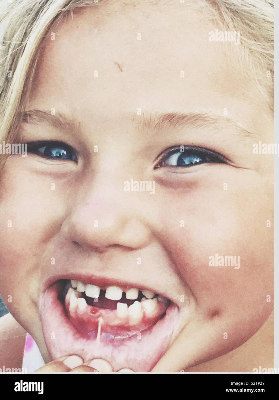 Young girl just lost a tooth Stock Photo - Alamy