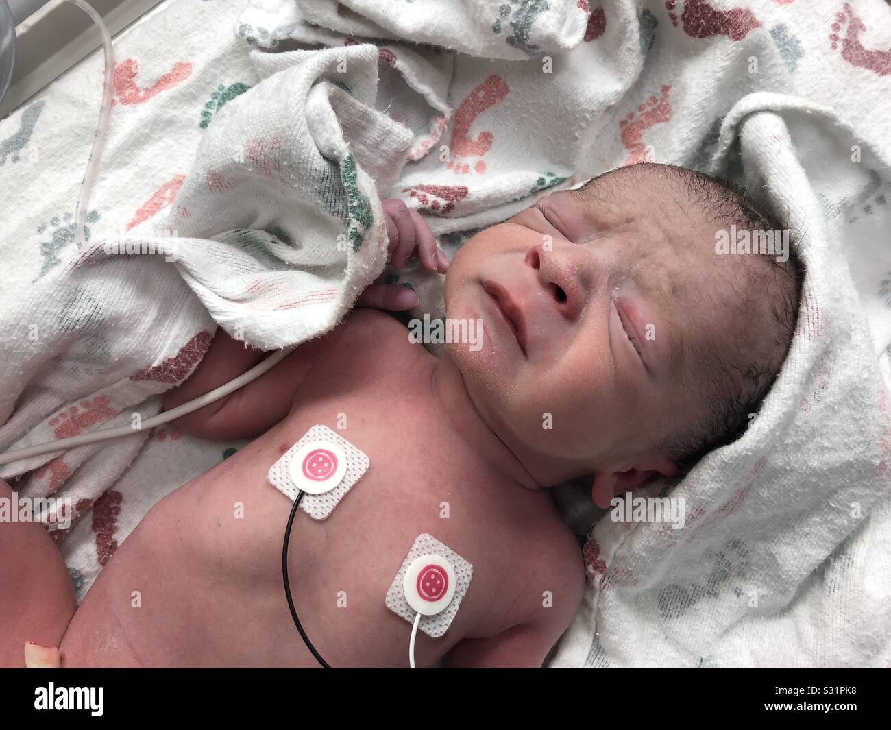 Newborn baby boy, born by cesarean. In hospital with heart electrodes ...