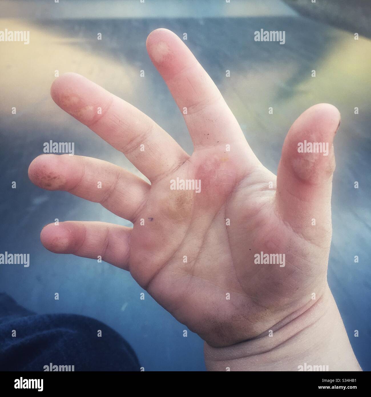 Blistering burns hi-res stock photography and images - Alamy