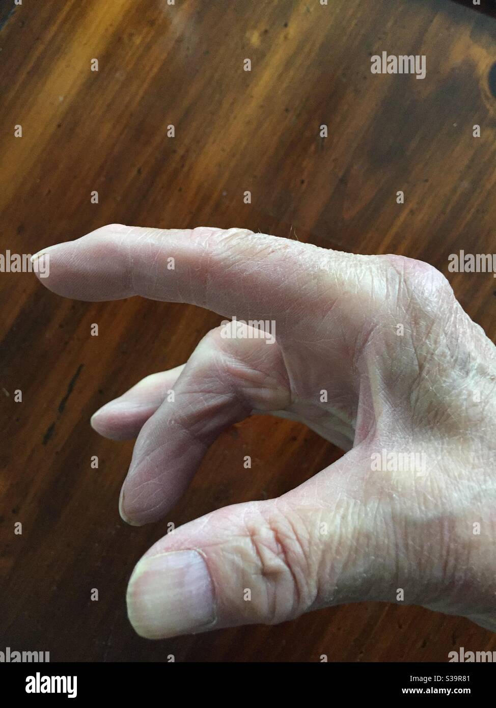 Dupuytren's contracture is a hand deformity Stock Photo - Alamy