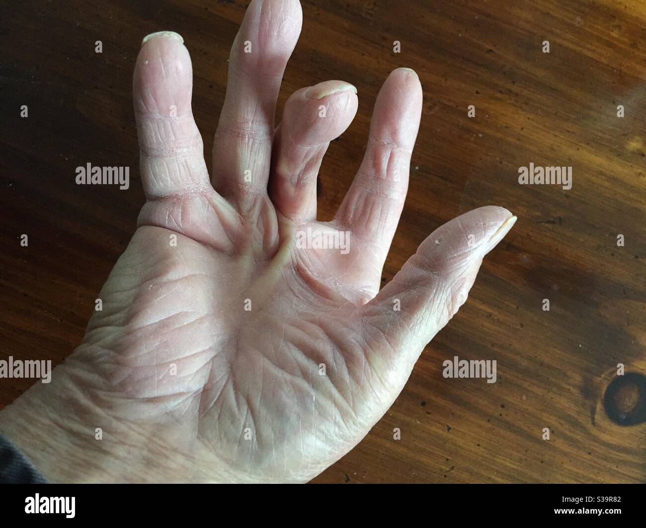 With deformity hi-res stock photography and images - Alamy