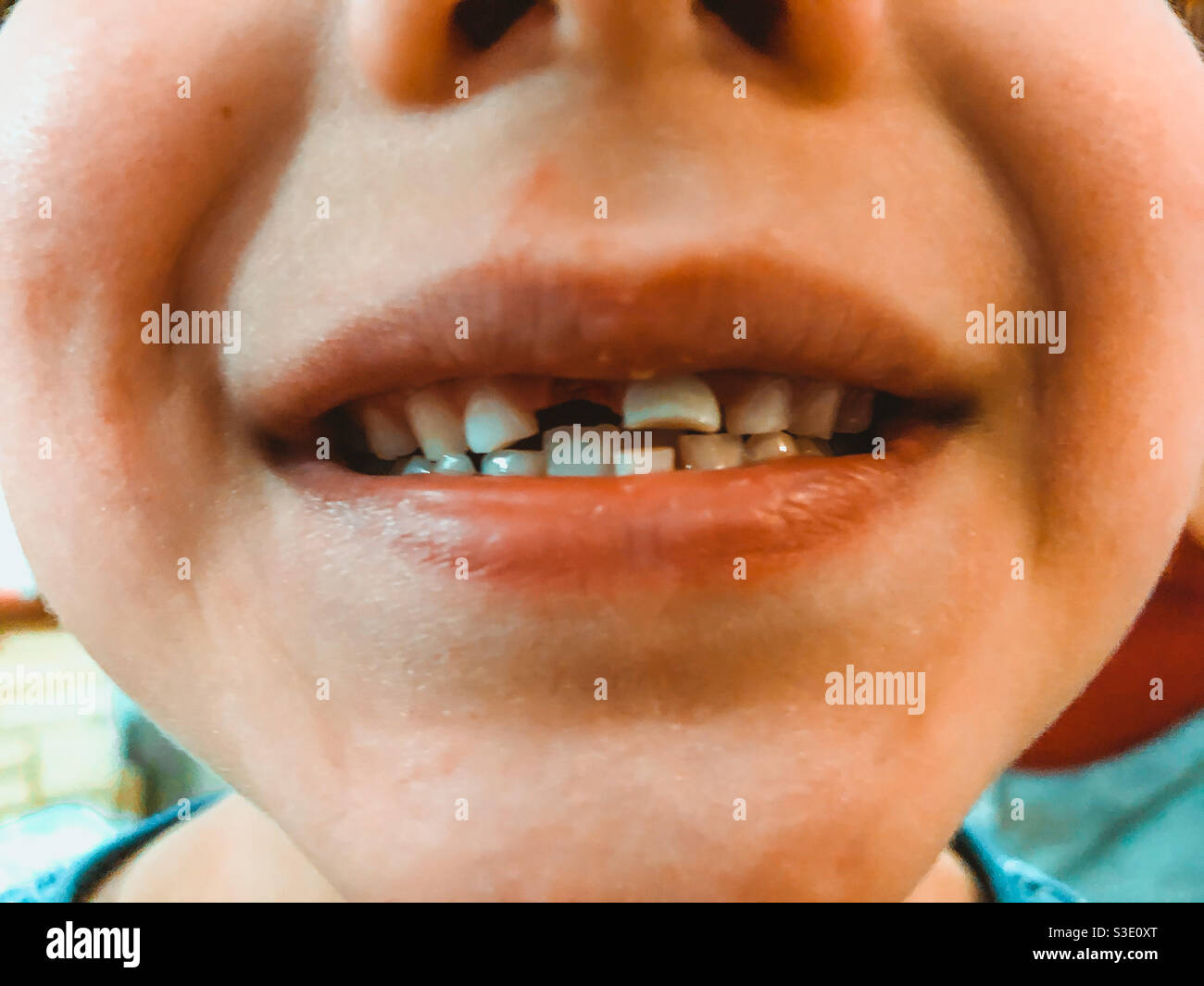 A young child has a gap among his top front teeth where a milk tooth ...