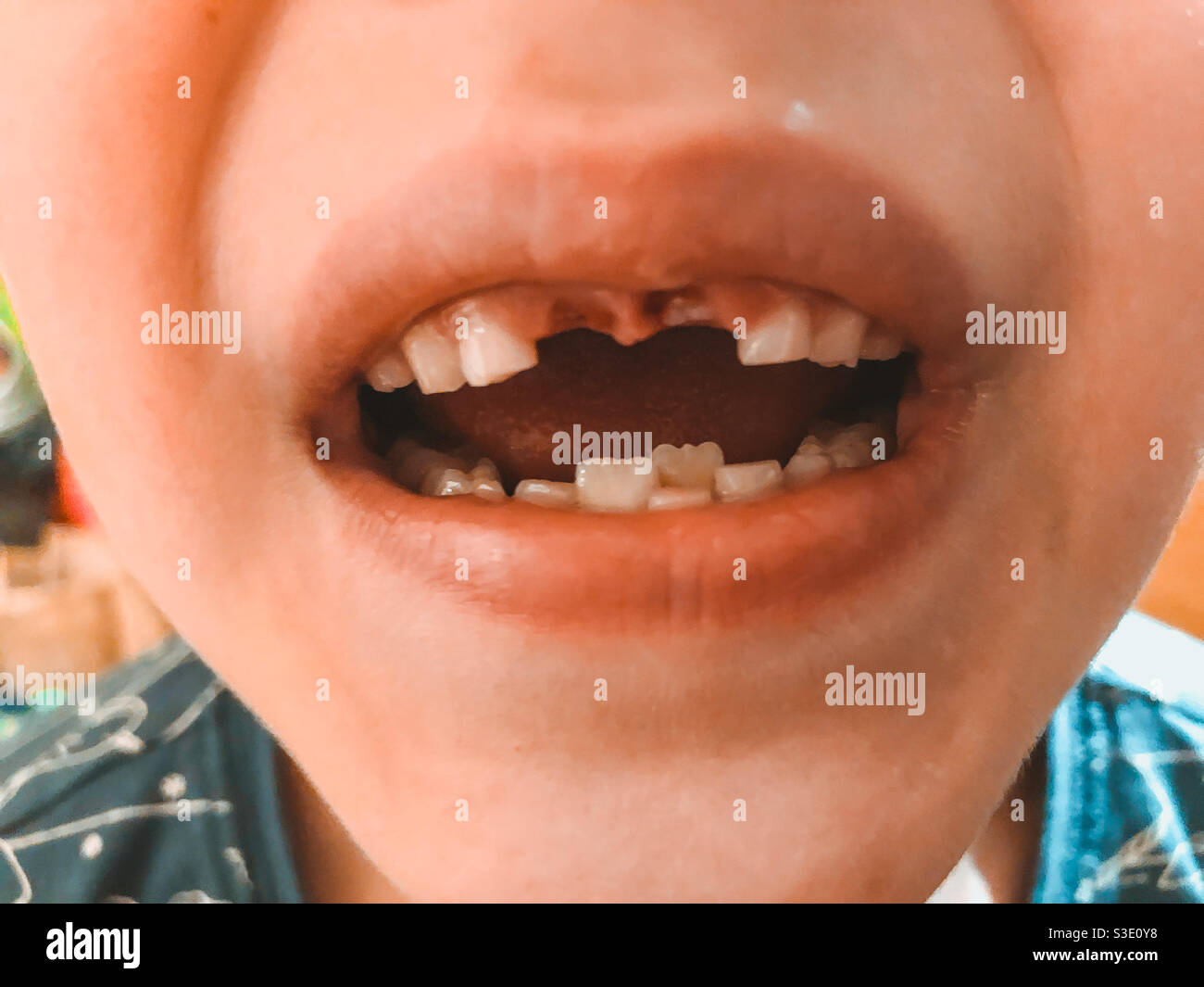 A young child has a gap where two milk teeth have fallen out Stock ...