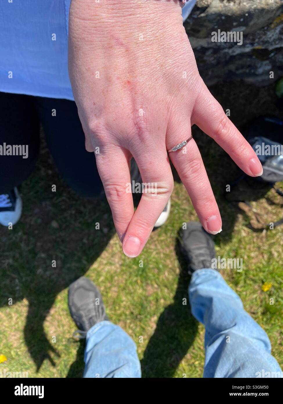 Dislocation finger hi-res stock photography and images - Alamy