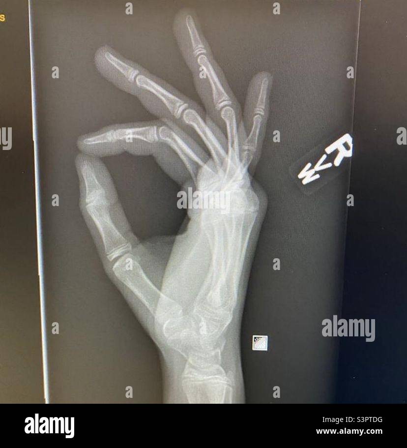 Hand x ray hi-res stock photography and images - Alamy