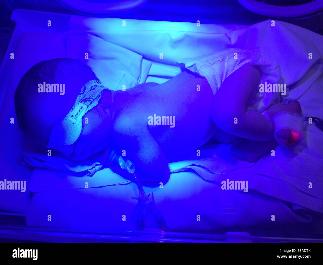 Jaundice treatment hi-res stock photography and images - Alamy
