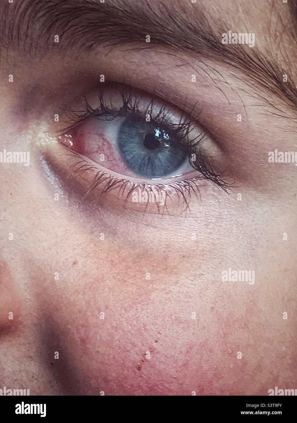 Red veins in eye hi-res stock photography and images - Alamy