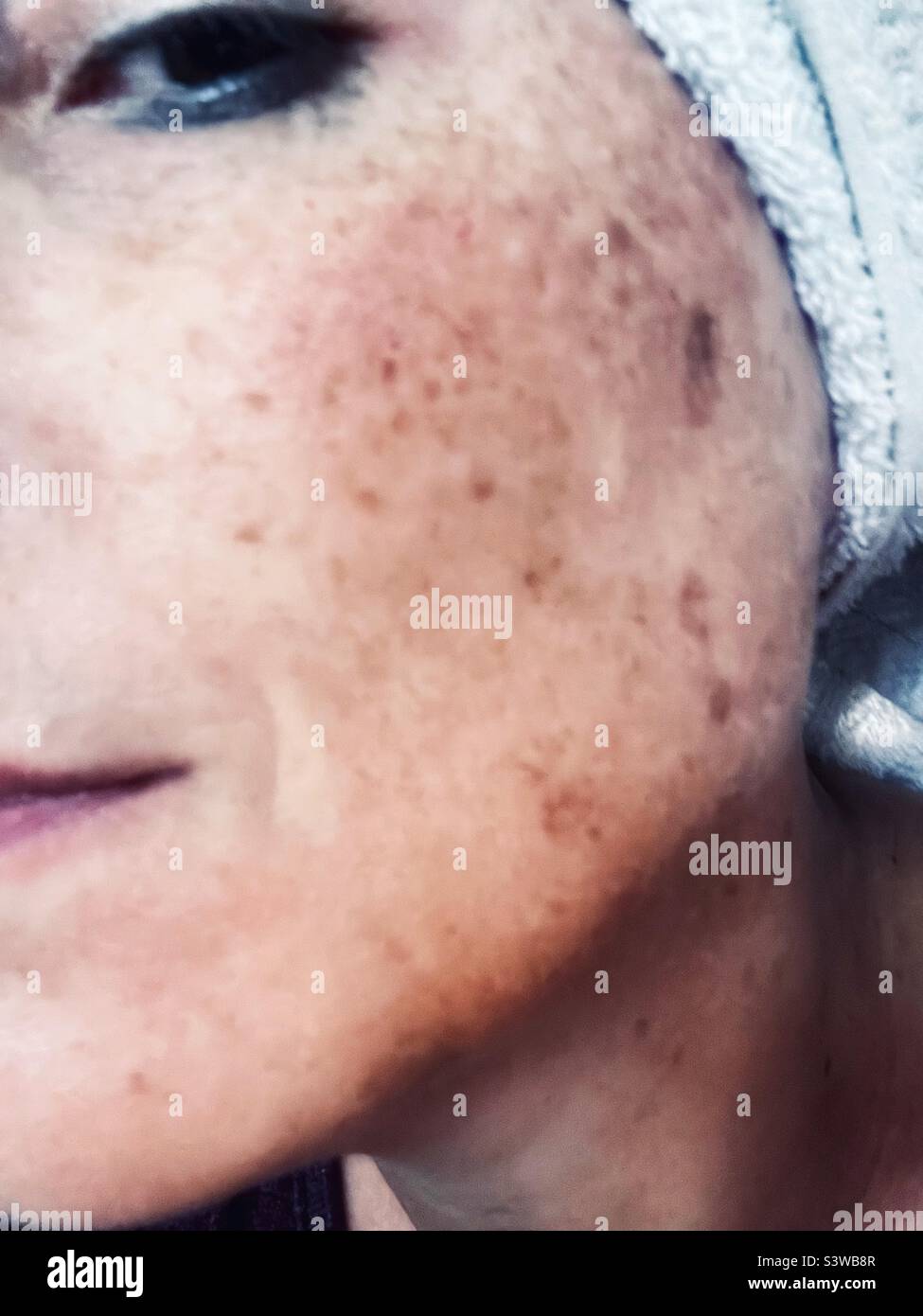 Skin imperfections hi-res stock photography and images - Alamy