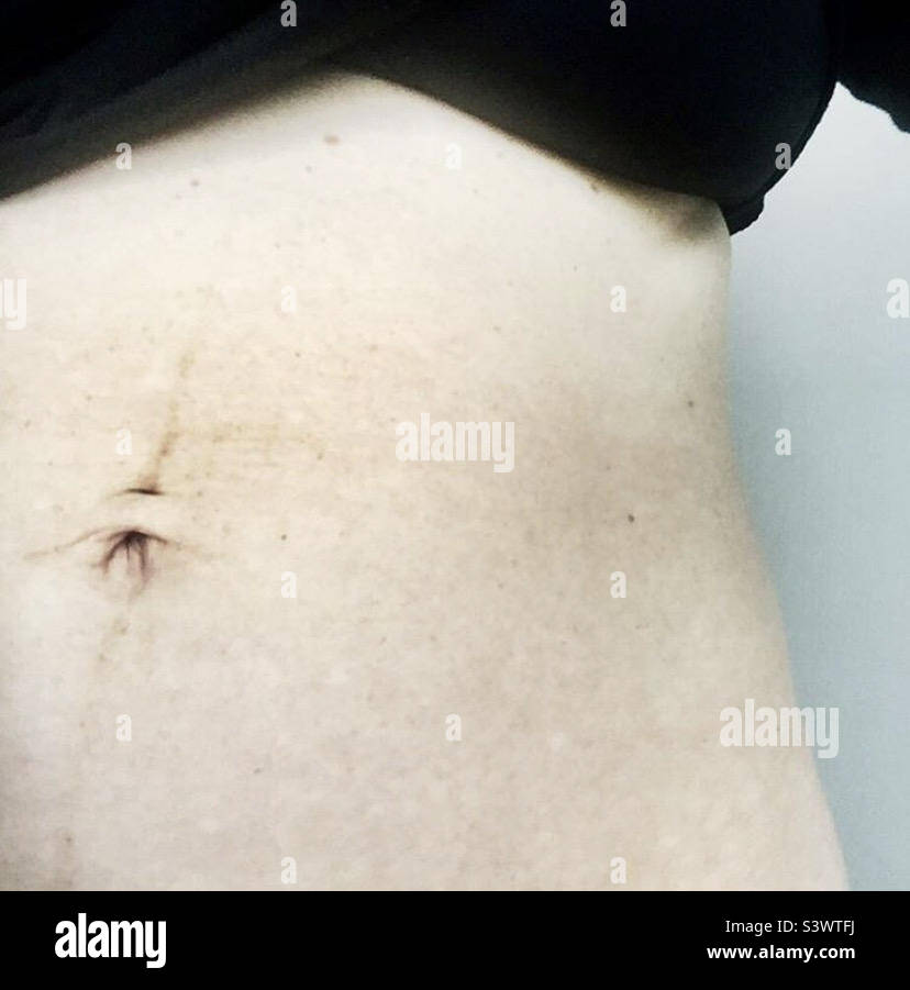 Diastasis rectii hi-res stock photography and images - Alamy