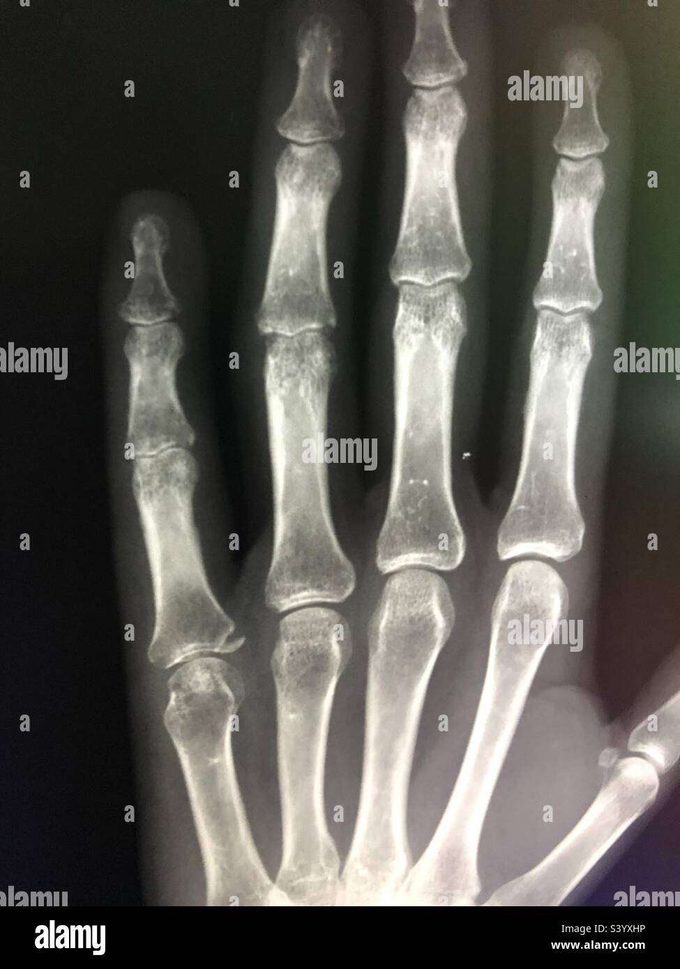 Xray Of Broken Finger