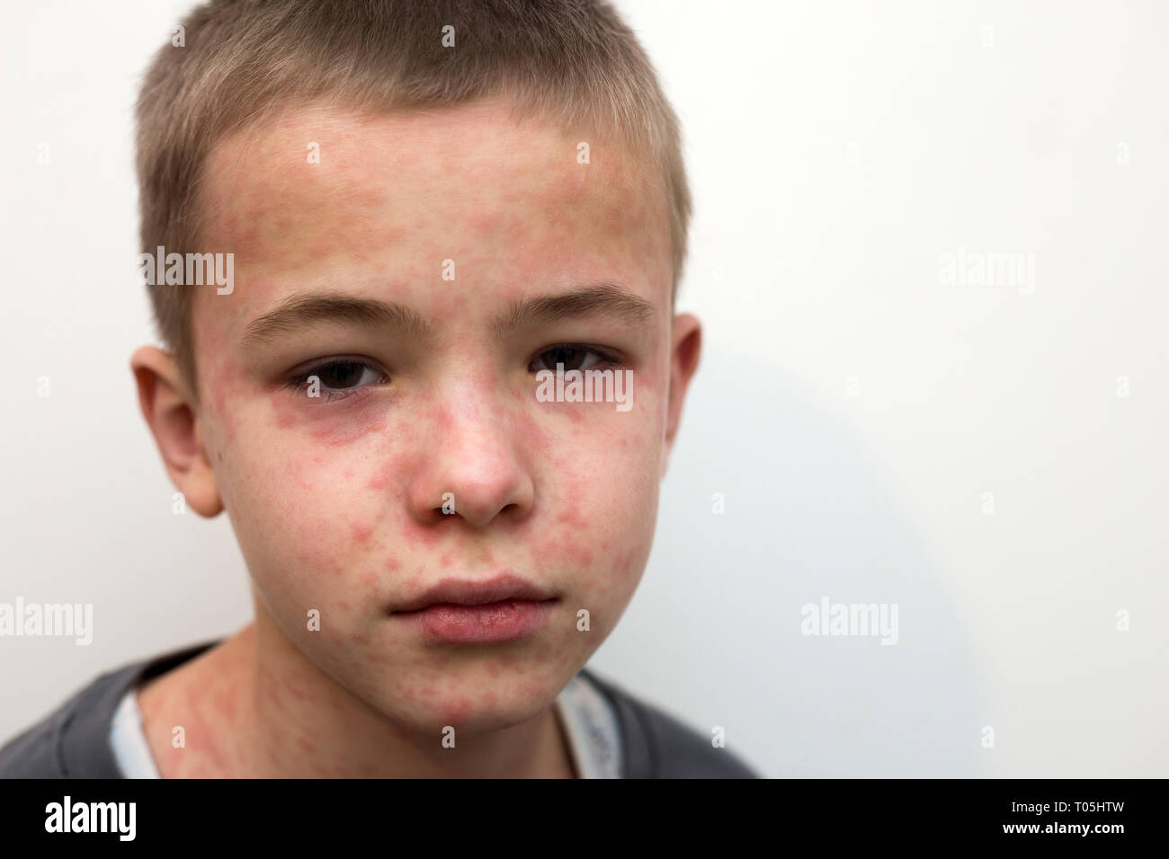Portrait of sick sad boy child suffering from measles or chicken pox ...