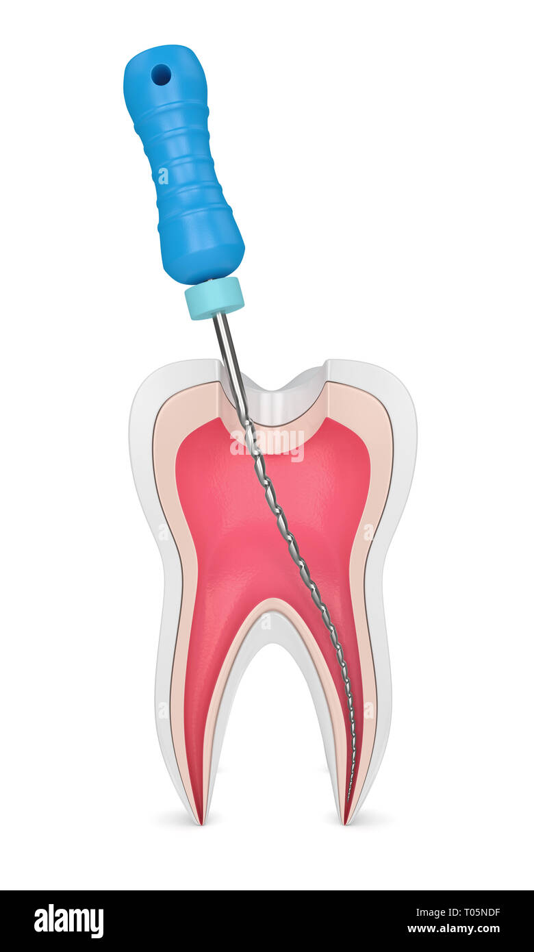 3d render of tooth with endodontic file over white background. Root ...