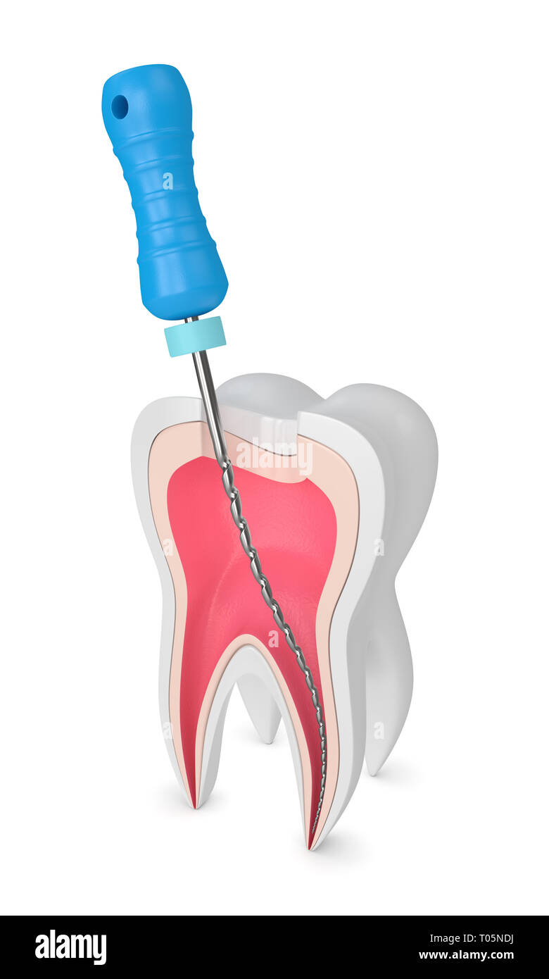 3d render of tooth with endodontic file over white background. Root ...