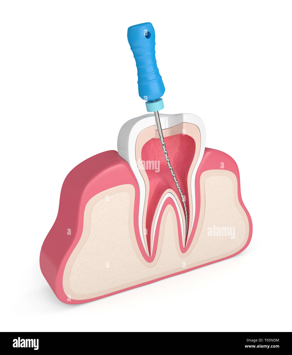 3d render of tooth with endodontic file in gums over white background ...