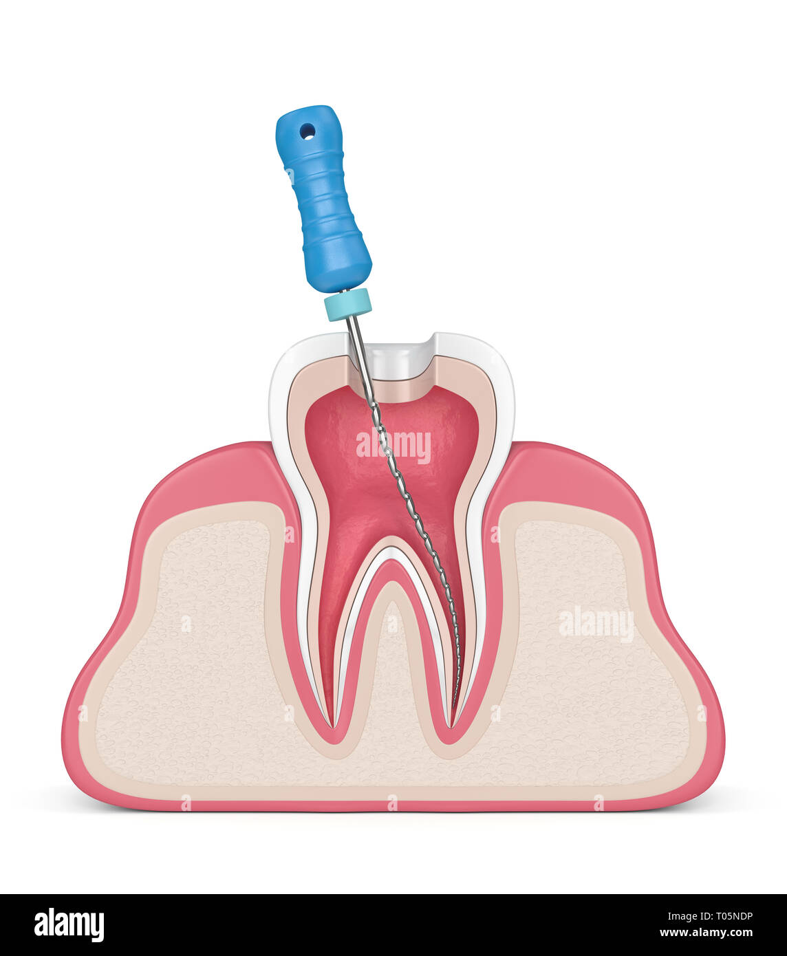 3d render of tooth with endodontic file in gums over white background ...