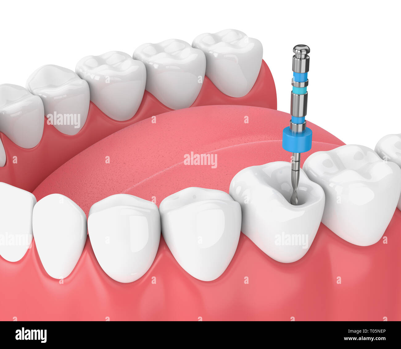 3d render of tooth with endodontic file in jaw over white background ...