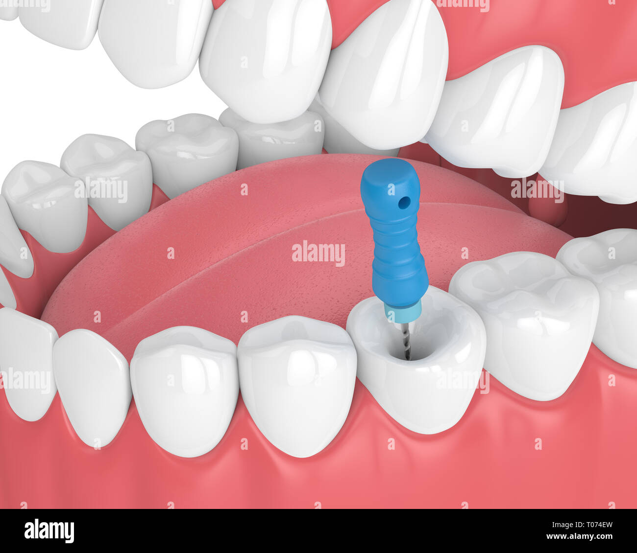 3d render of tooth with endodontic file in jaw over white background ...