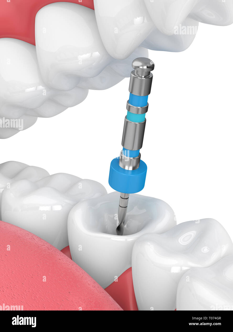 3d render of tooth with endodontic file in jaw over white background ...
