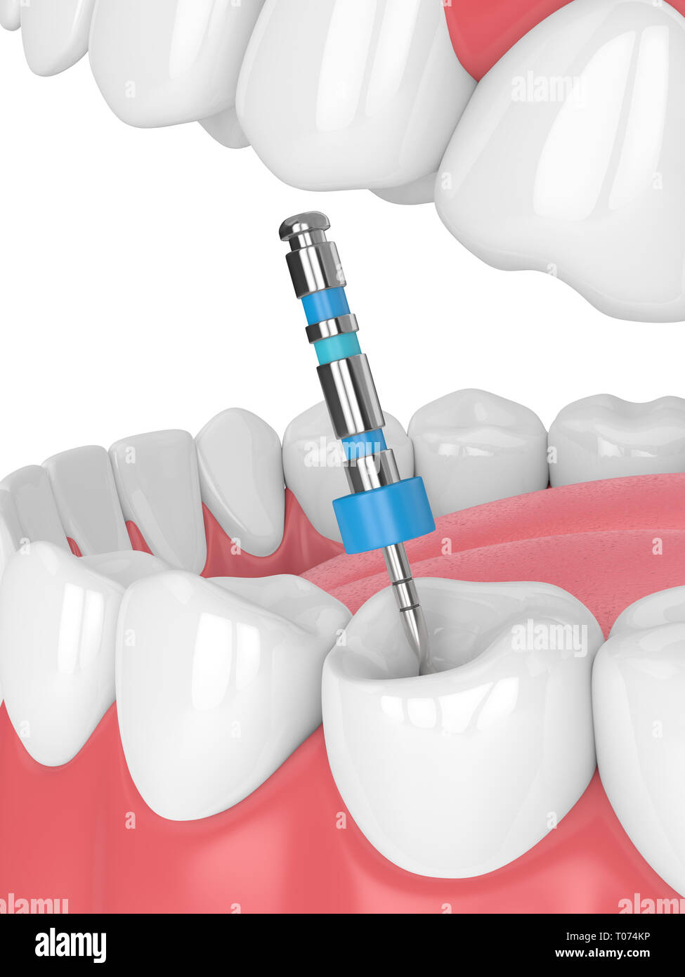 3d render of tooth with endodontic file in jaw over white background ...
