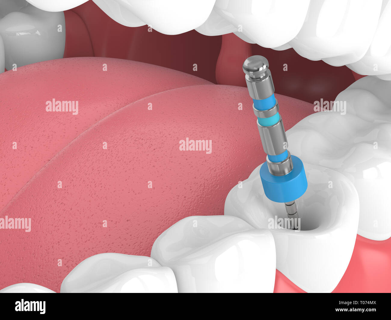 3d render of tooth with endodontic file in jaw over white background ...