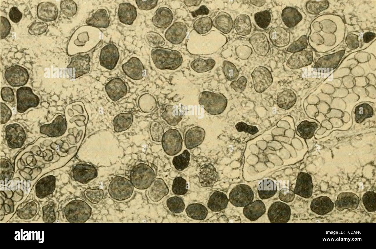 The effects of inanition and Stock Photo - Alamy