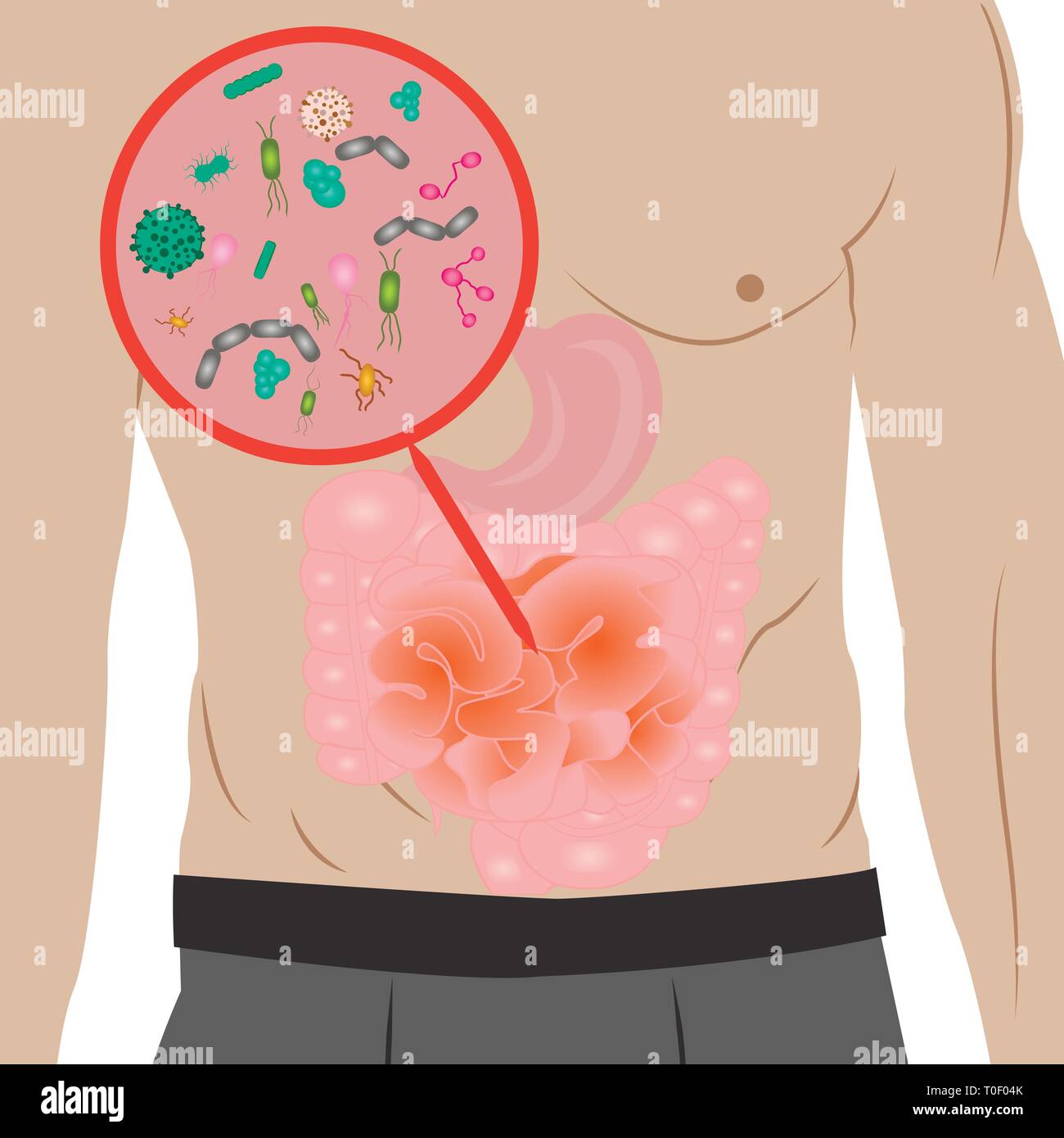 Bacterial overgrowth syndrome hi-res stock photography and images - Alamy