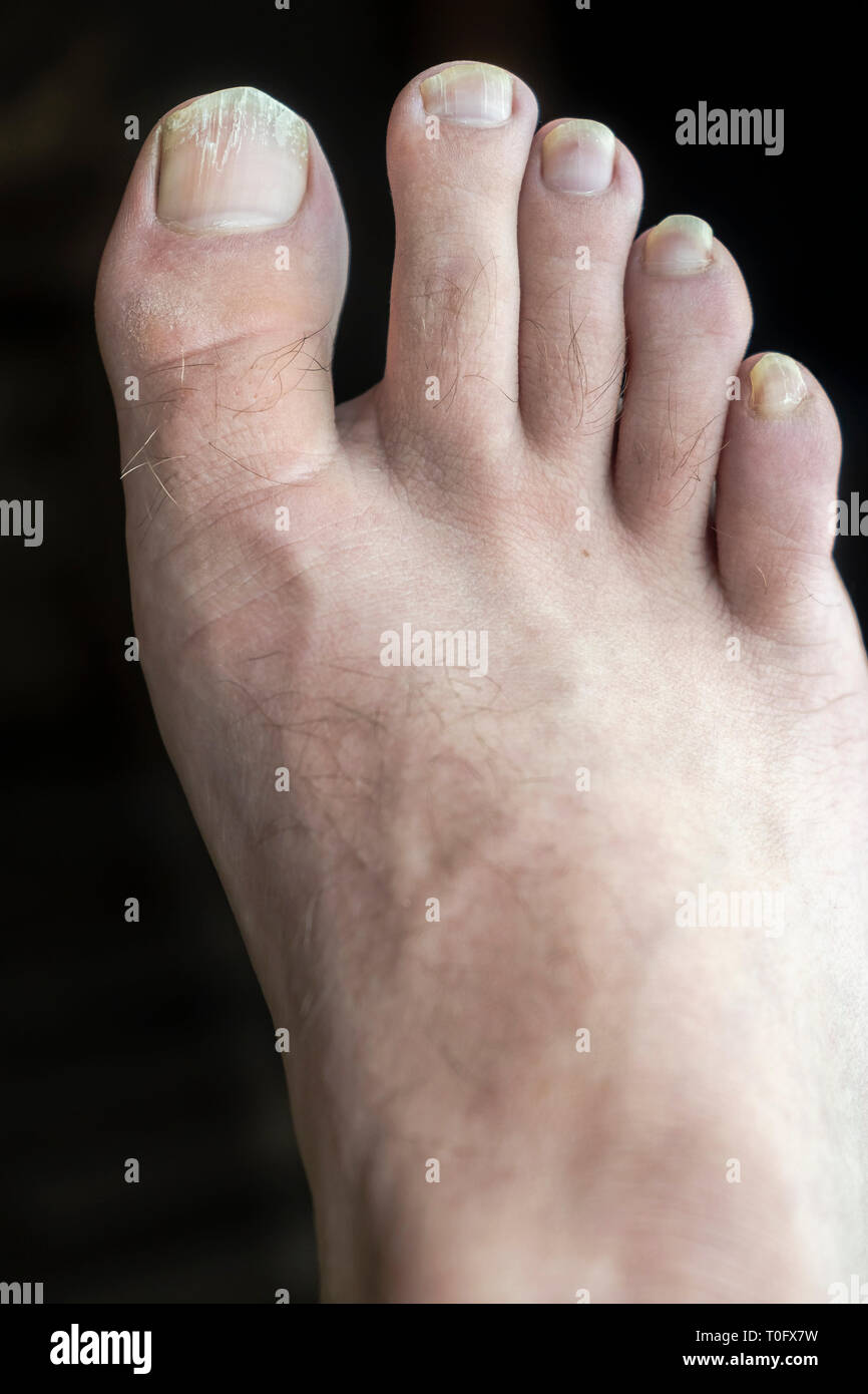 Gangrene foot hi-res stock photography and images - Alamy