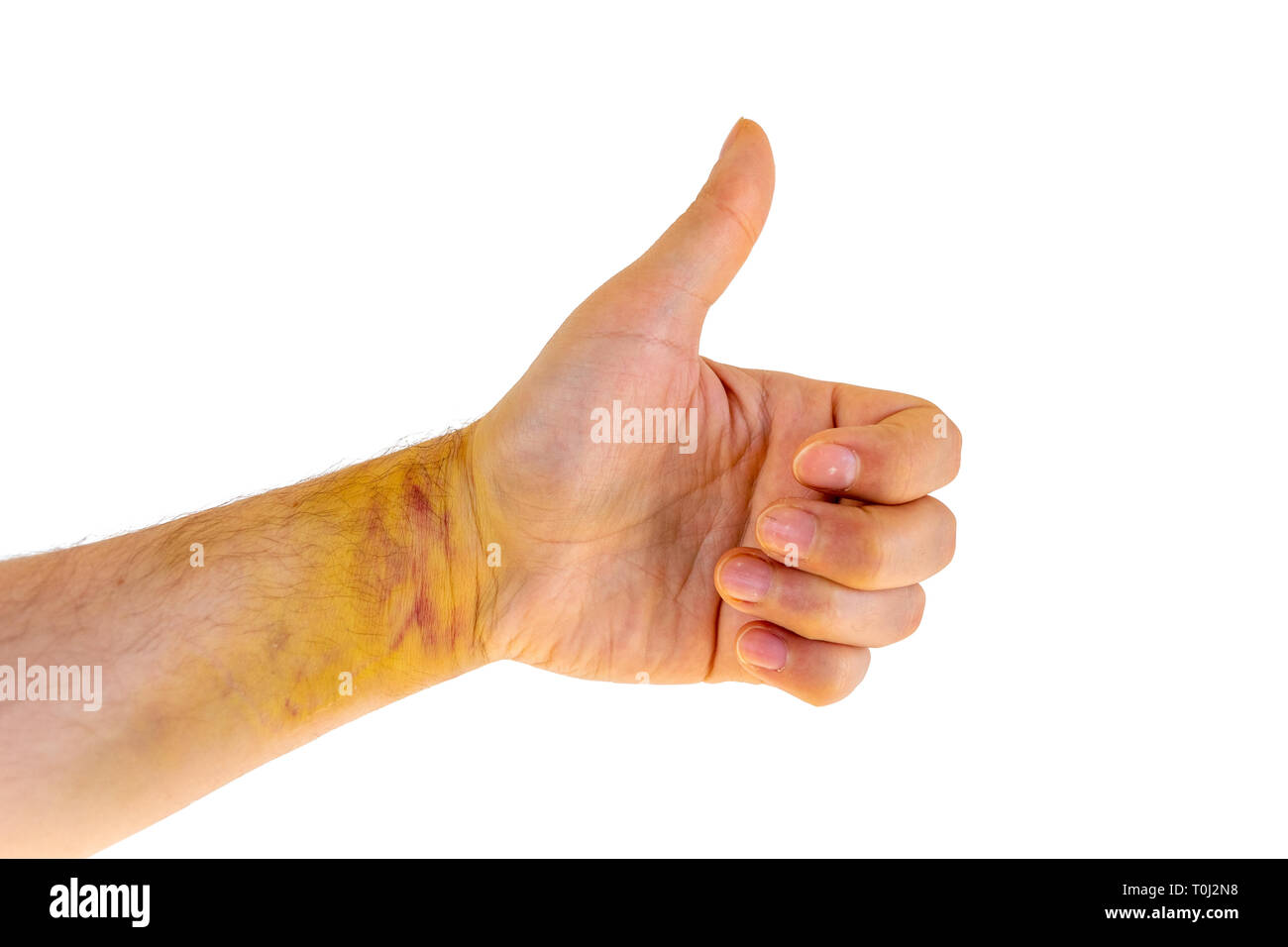 Sprained wrist injury showing signs of healing, isolated on white ...