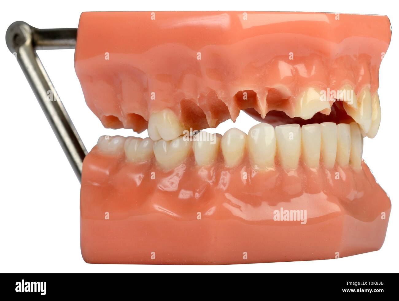 Additional molar teeth hi-res stock photography and images - Alamy