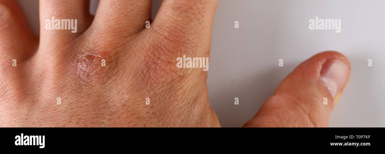 Man skin disease hi-res stock photography and images - Alamy