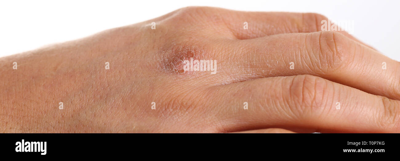 Damaged male arm with corrupted dry skin Stock Photo - Alamy