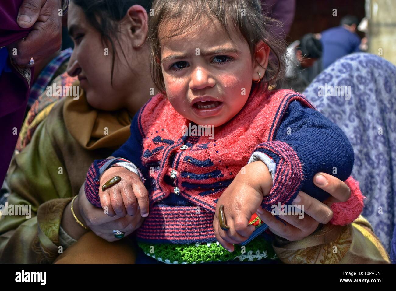 March 21, 2019 - Srinagar, J&K, India - A young patient seen with ...