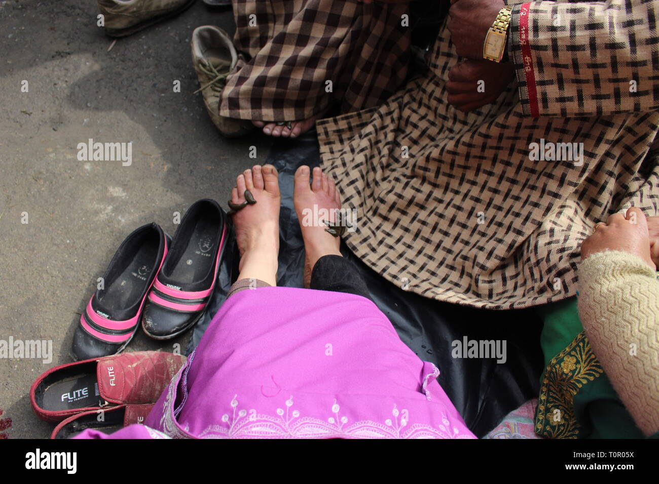 Srinagar, Kashmir. 21st Mar, 2019. A local Kashmiris receives leeches ...