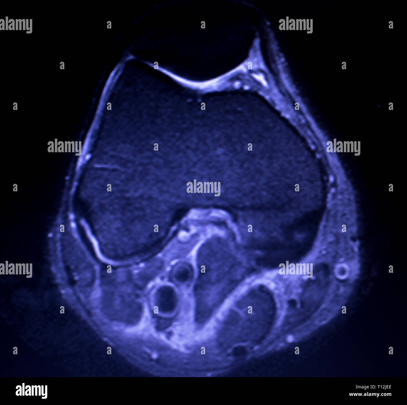 Magnetic resonance imaging MRI knee posterior horn medial meniscus tear ...
