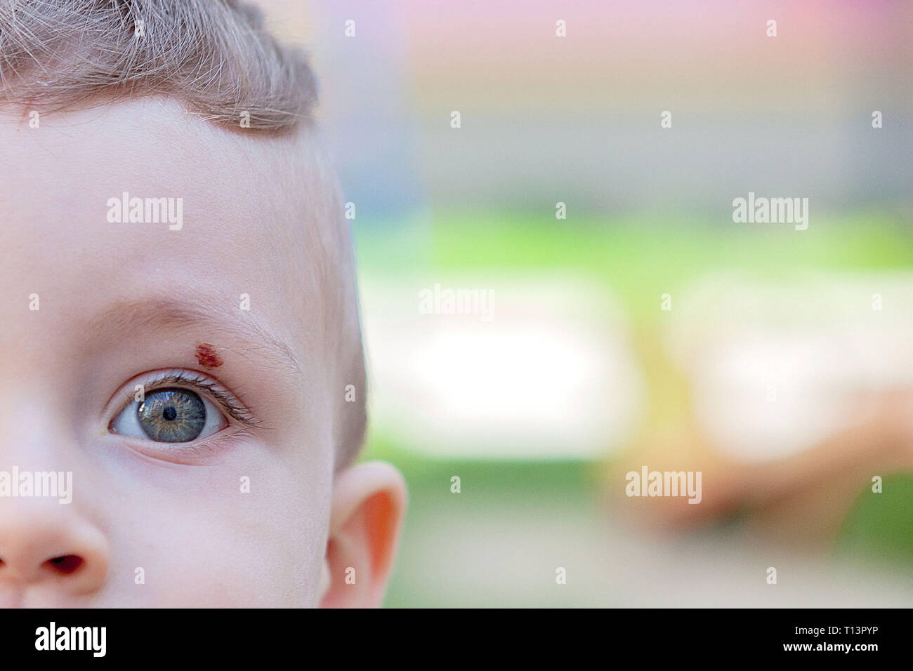 Child hematoma hi-res stock photography and images - Alamy