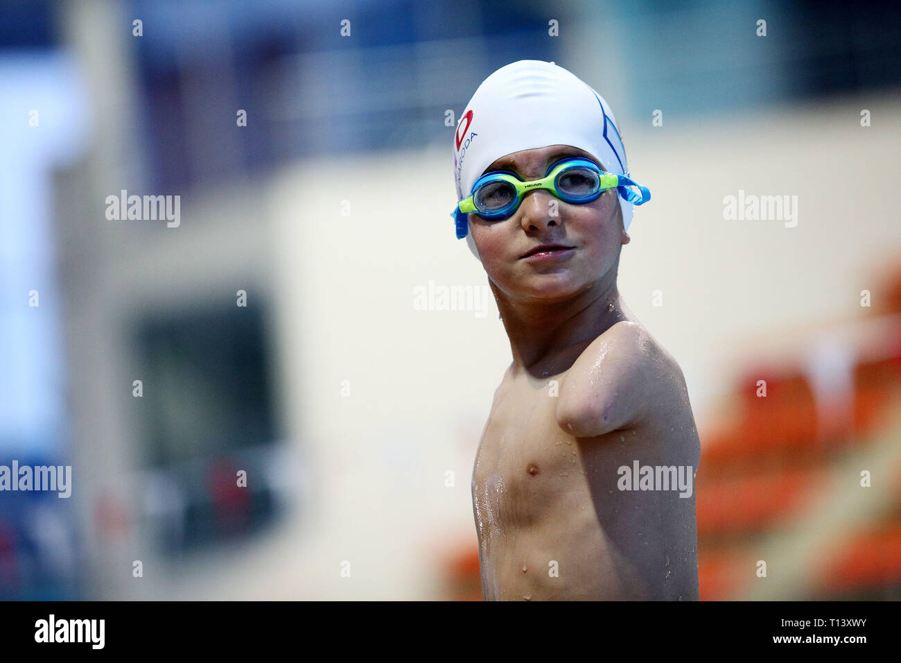 Deformed leg hi-res stock photography and images - Alamy