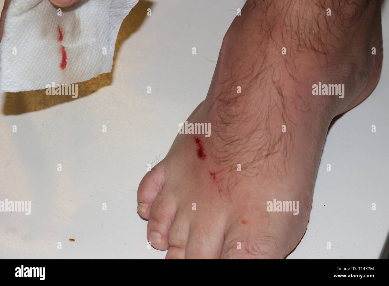 Injured foot with bleeding abrasion wound isolated on white background ...