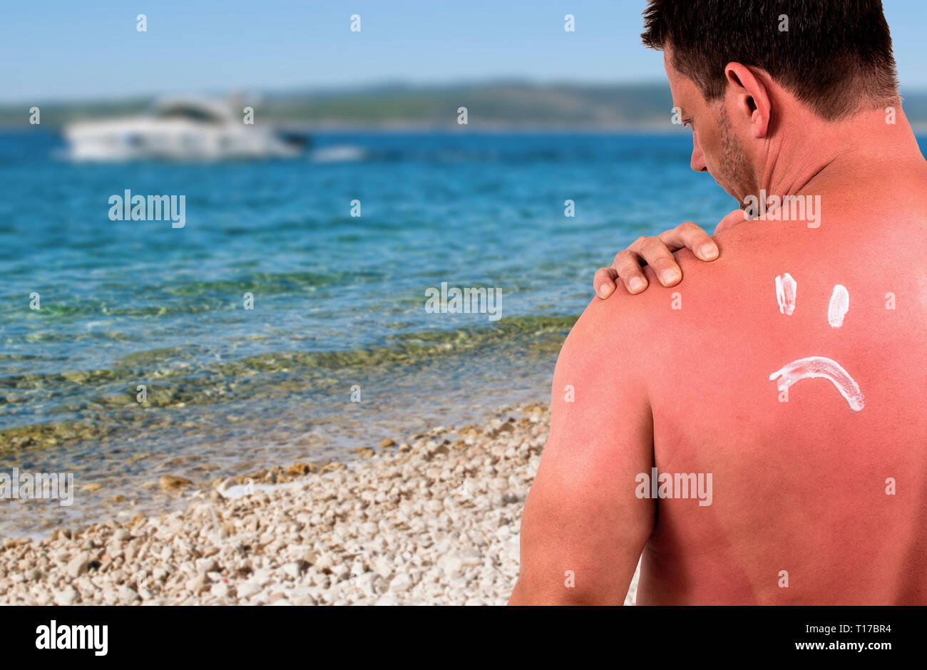 Man with sunburned skin and ocean beach Stock Photo - Alamy