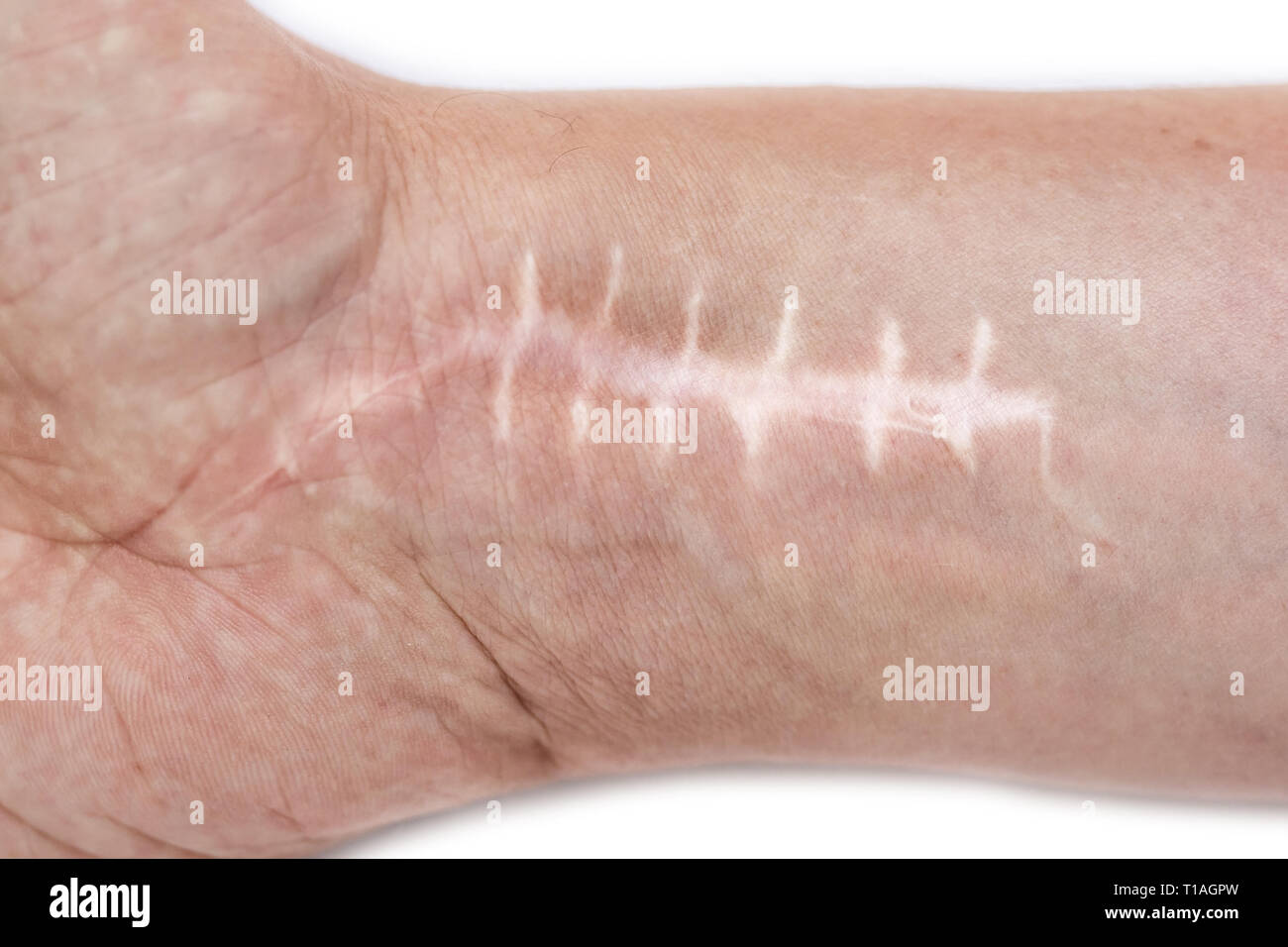 Operation Scar High Resolution Stock Photography and Images - Alamy