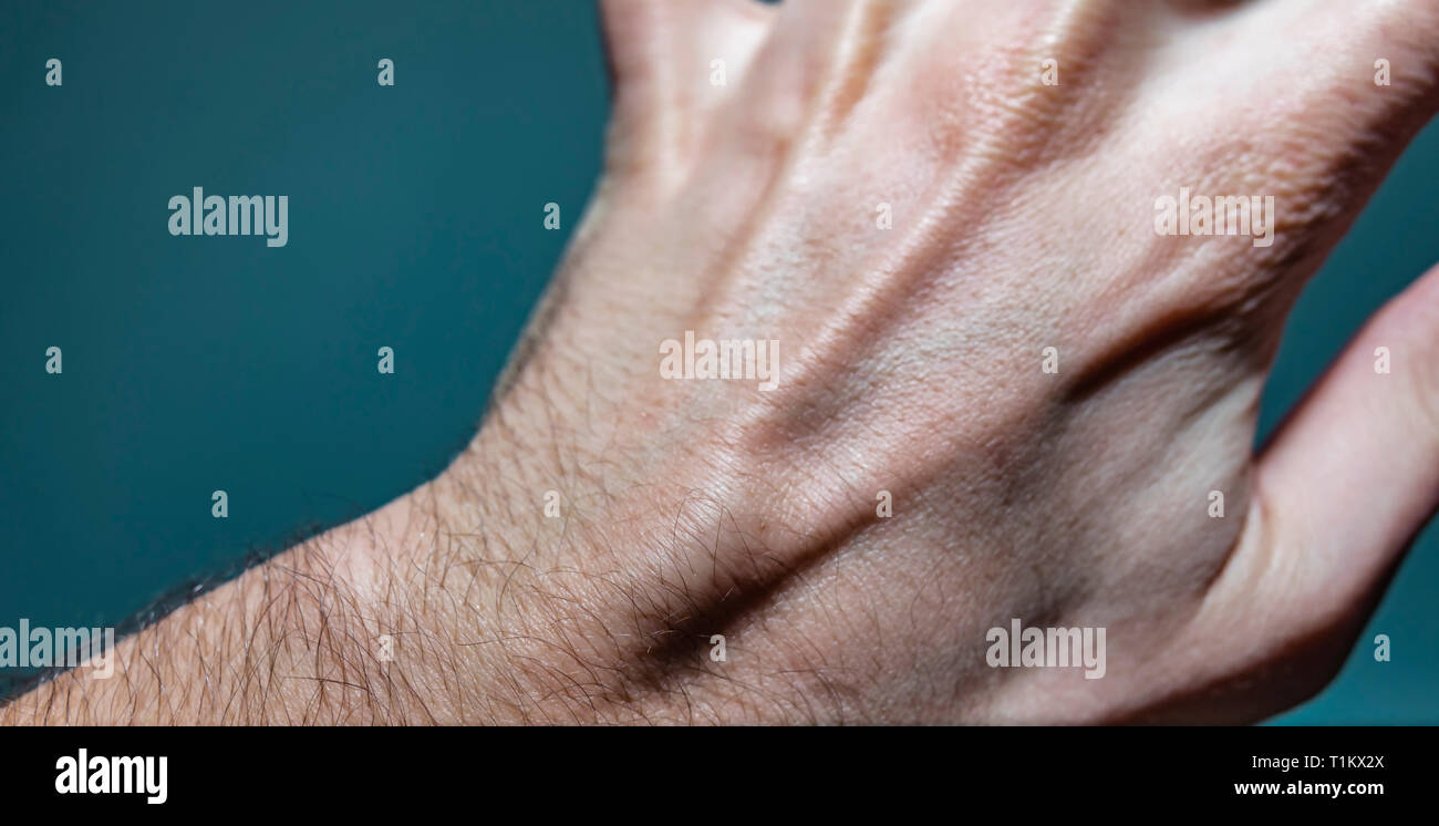 Close up shot of a white caucasian man left hand with a ganglion cyst ...