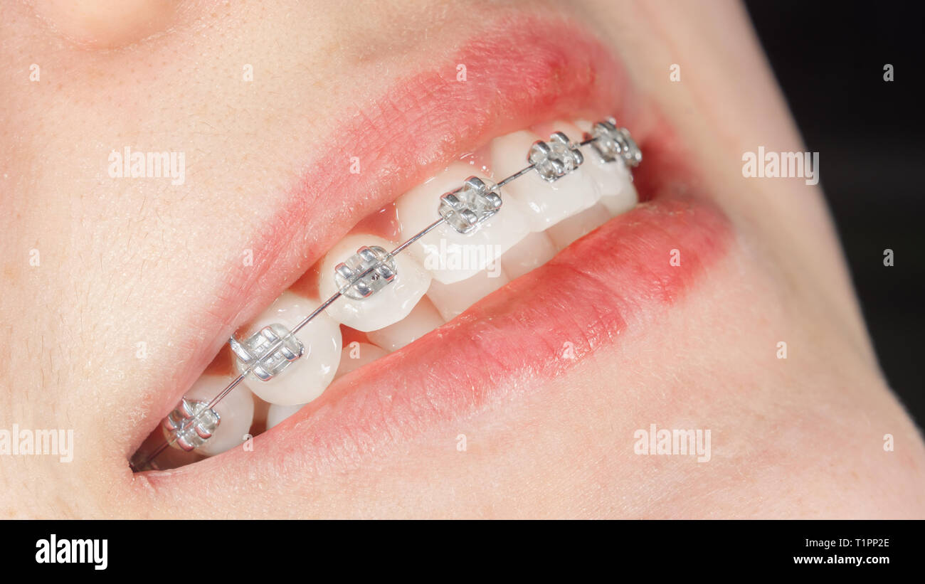 dental braces close-up during treatment in an orthodontist. Aesthetic a ...