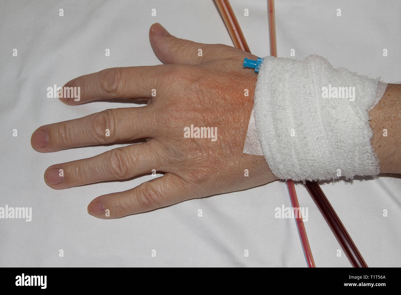 Man's hand with cannula in hospital, plastic tube with blood Stock ...