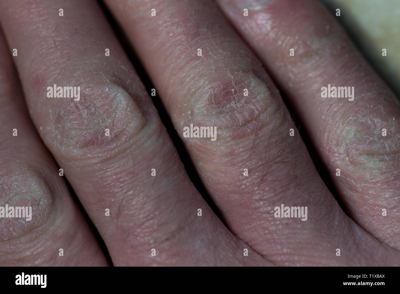 Close up of hands with dry skin damage. Dermatology concept human hands ...