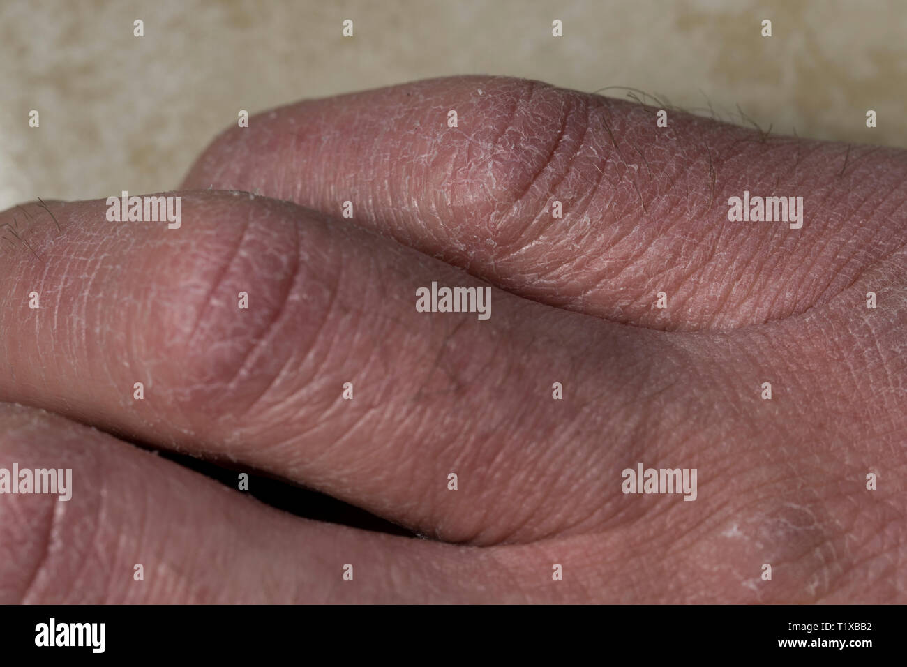 Cracked skin hi-res stock photography and images - Alamy