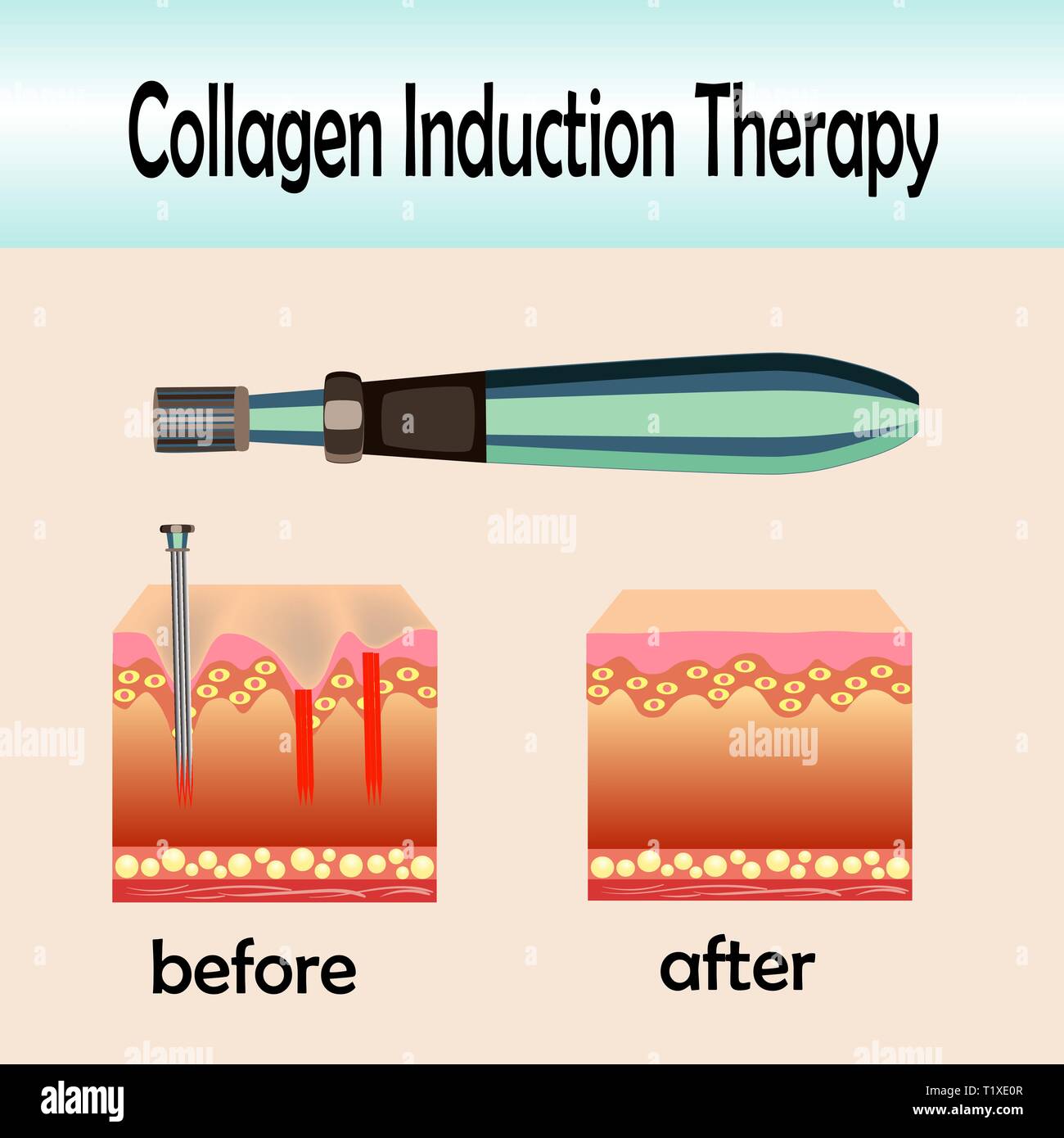 Needle marks hi-res stock photography and images - Alamy