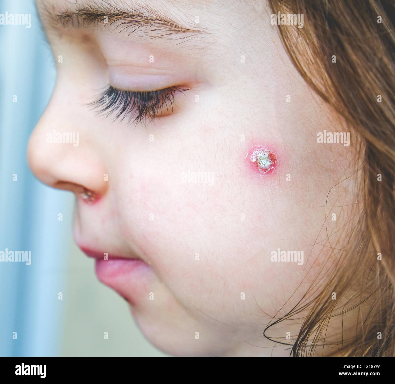 Scab close up hi-res stock photography and images - Alamy