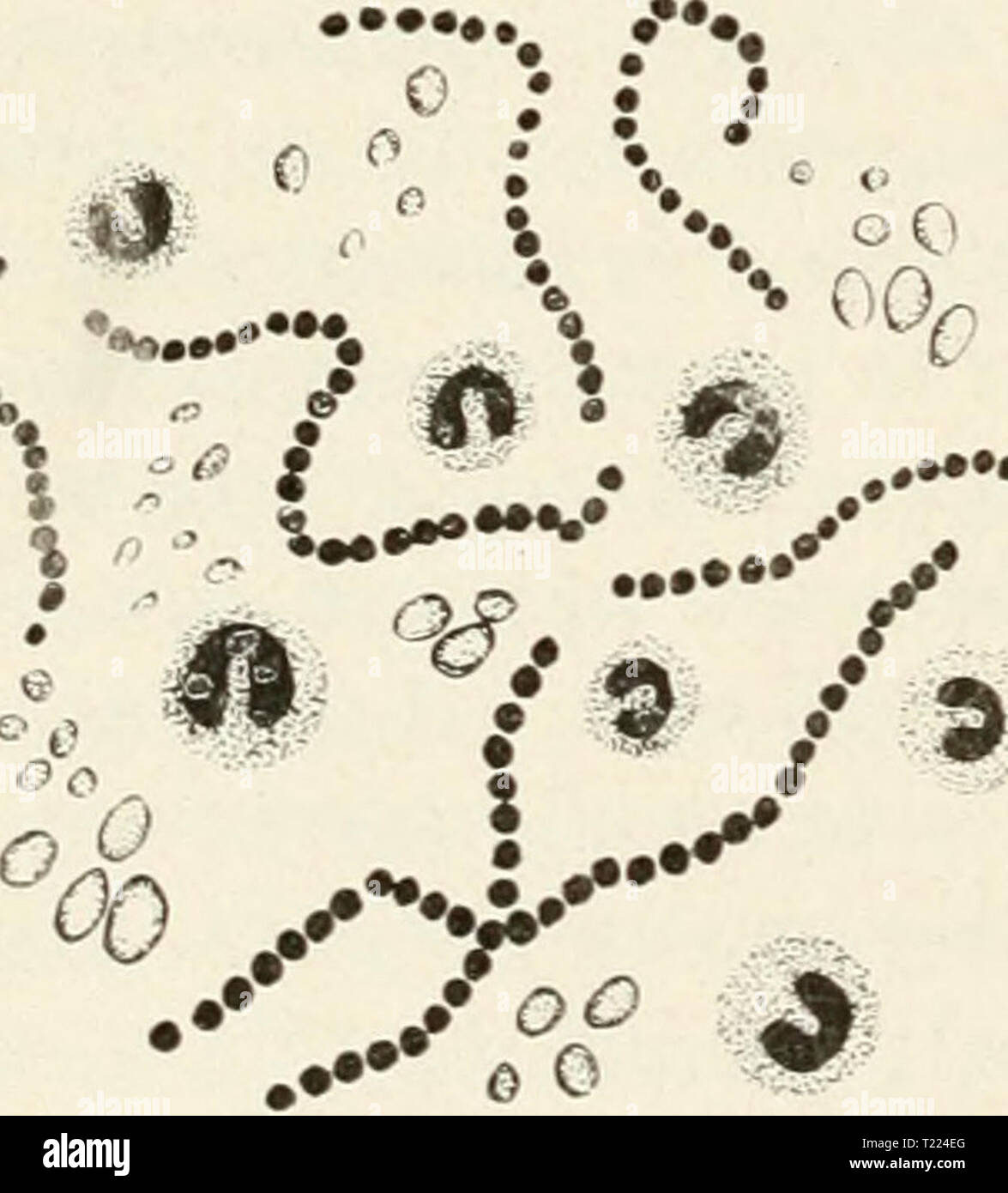 Formation of an abscess hi-res stock photography and images - Alamy