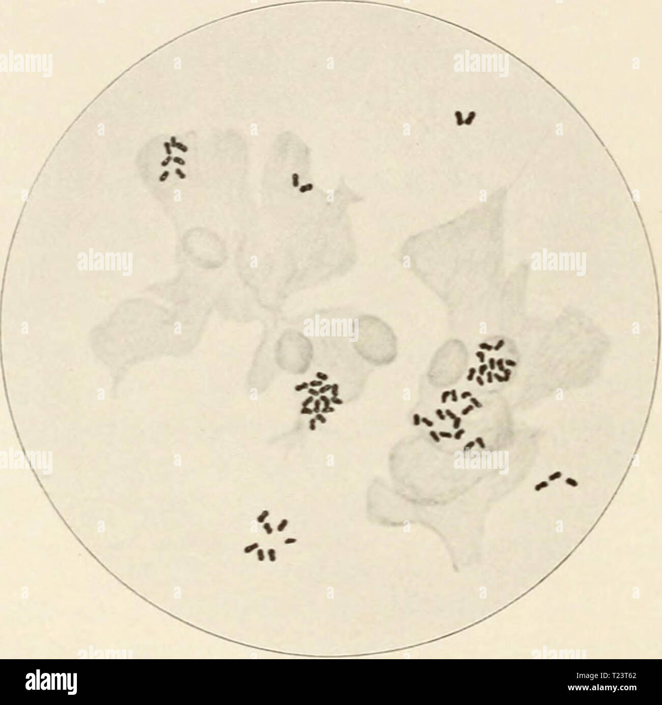 Pus cells hi-res stock photography and images - Alamy
