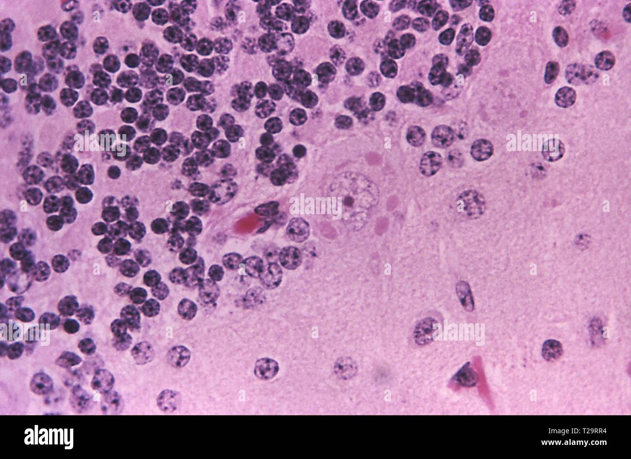 Photomicrograph of the cellular changes hi-res stock photography and ...