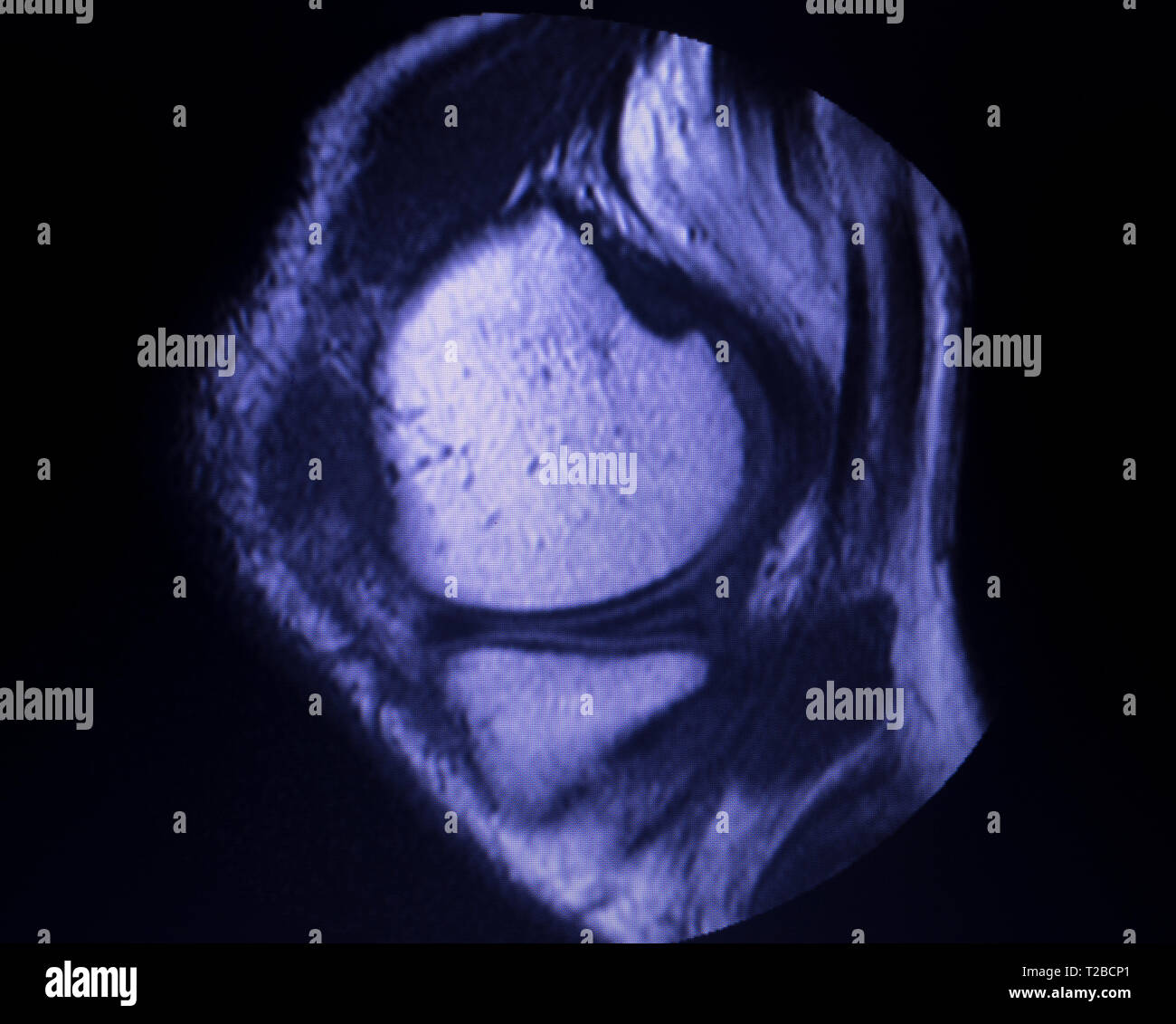 Magnetic resonance imaging MRI knee posterior horn medial meniscus tear ...